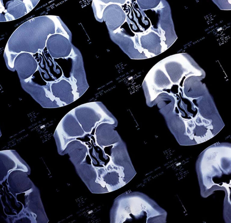 Cerebrospinal Fluid Leak | UCI Head and Neck Surgery - UCI ENT Doctors ...