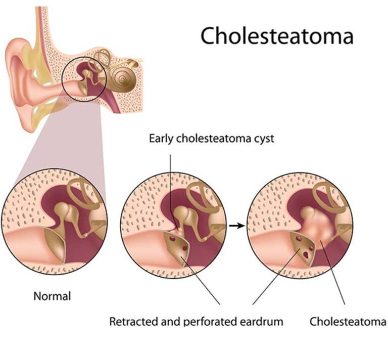 Petrous Apex Lesions, Cholesterol Granuloma, Cyst, Cholesteatoma | UCI ...