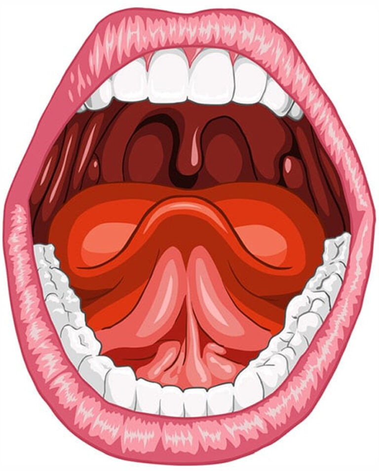 Salivary Gland Stones | UCI Head and Neck Surgery - UCI ENT Doctors ...