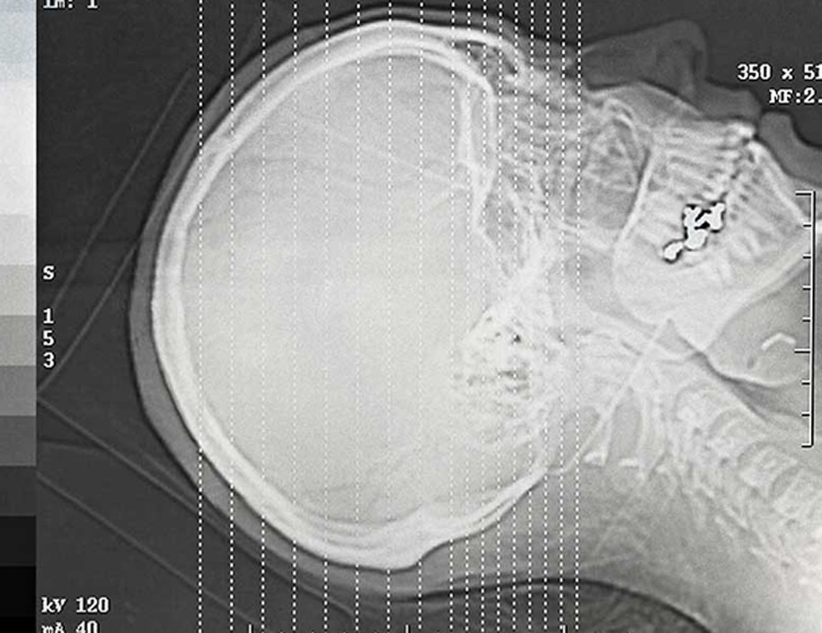 Sialoendoscopy | UCI Head and Neck Surgery - UCI ENT Doctors ...