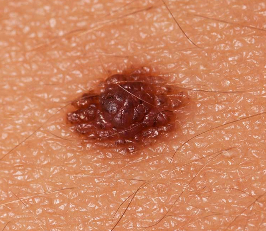 Skin Cancer | UCI Head and Neck Surgery - UCI ENT Doctors ...